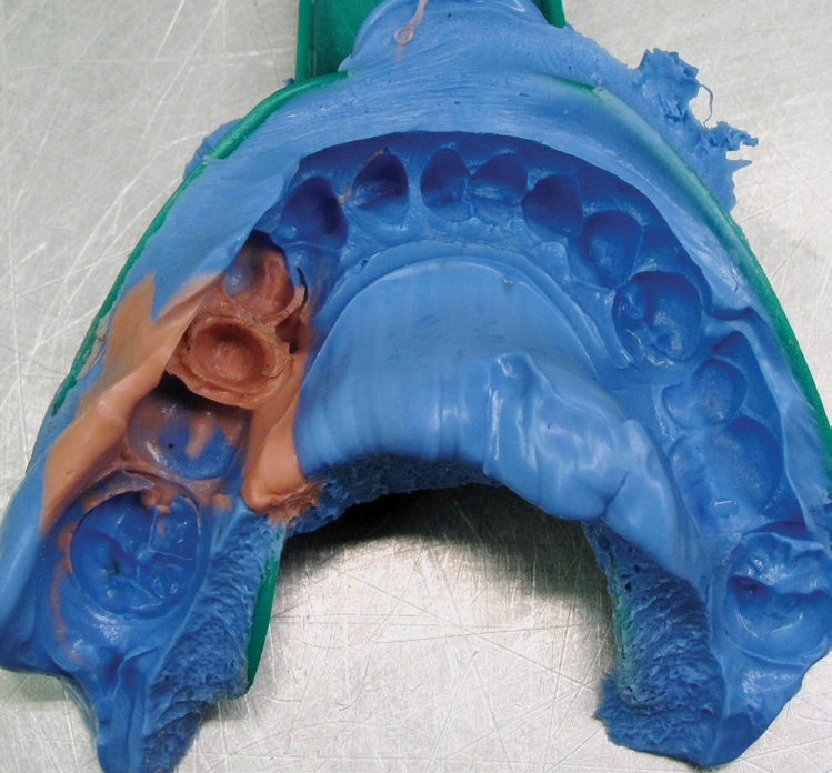 Tips - DentCarft Dental LaboratoryDentCarft Dental Laboratory